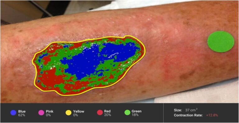 WoundKare: AR Wound Management with DeepSkin | WiredWhite